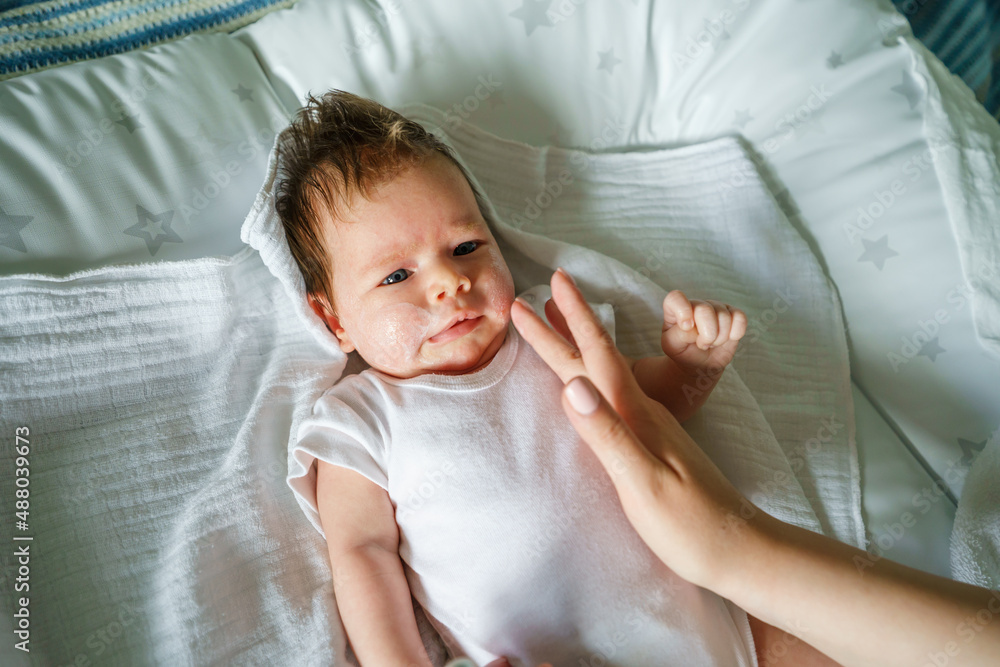 Neurodermatitis Chronic constitutional atopic eczema small newborn baby ...