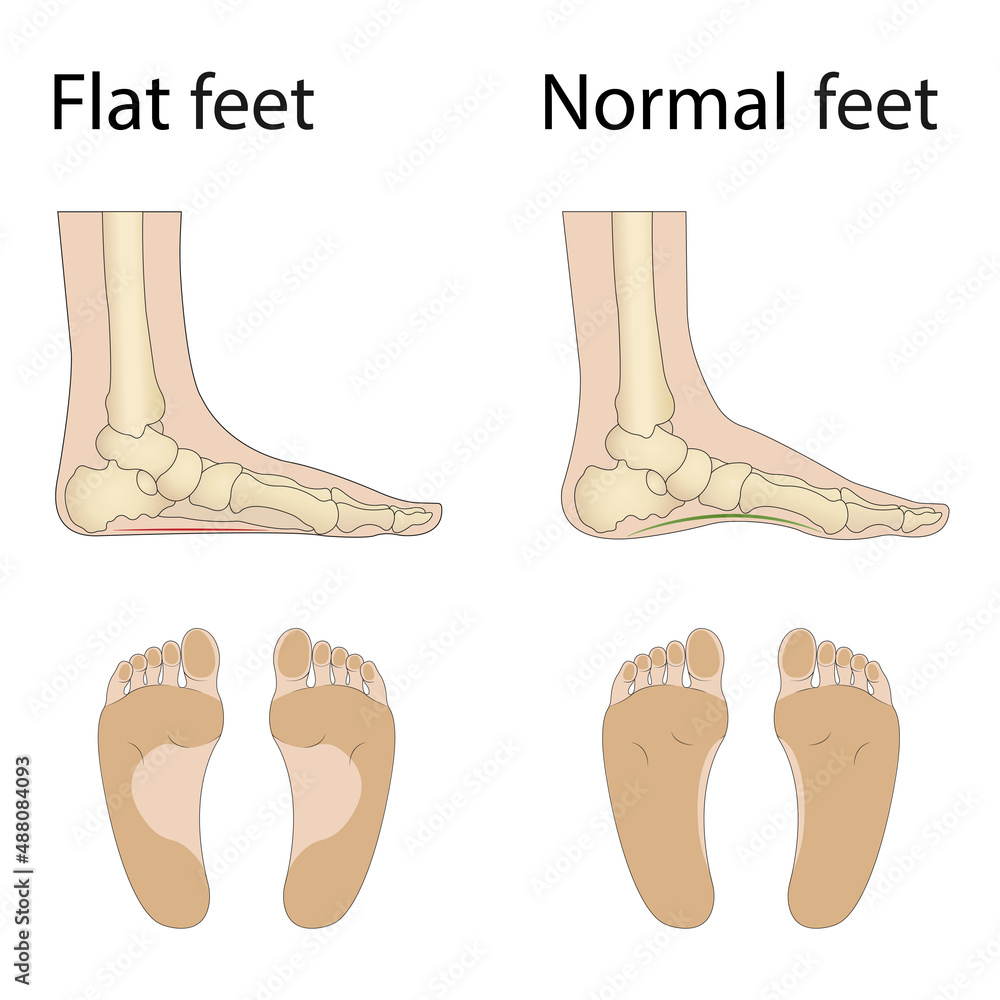 Foot deformity types, medical disease infographics. Hollow, flat, and ...