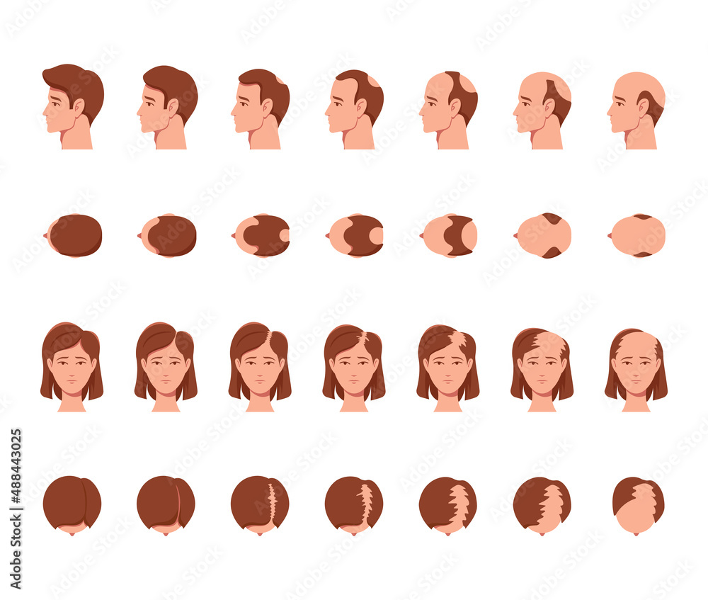 Stages of Baldness of Men and Women. Male and Female Characters Head ...