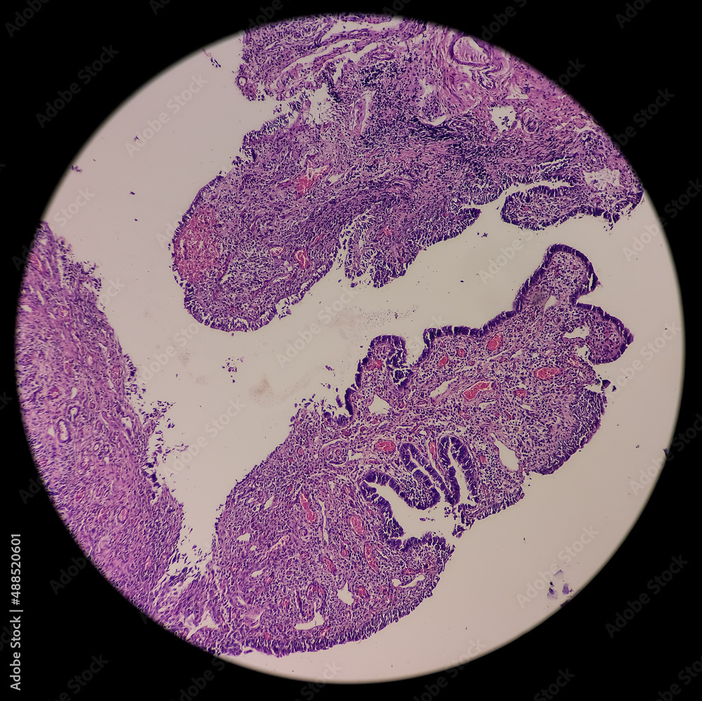 Urinary bladder(biopsy): Chronic cystitis, microscopic show bladder ...