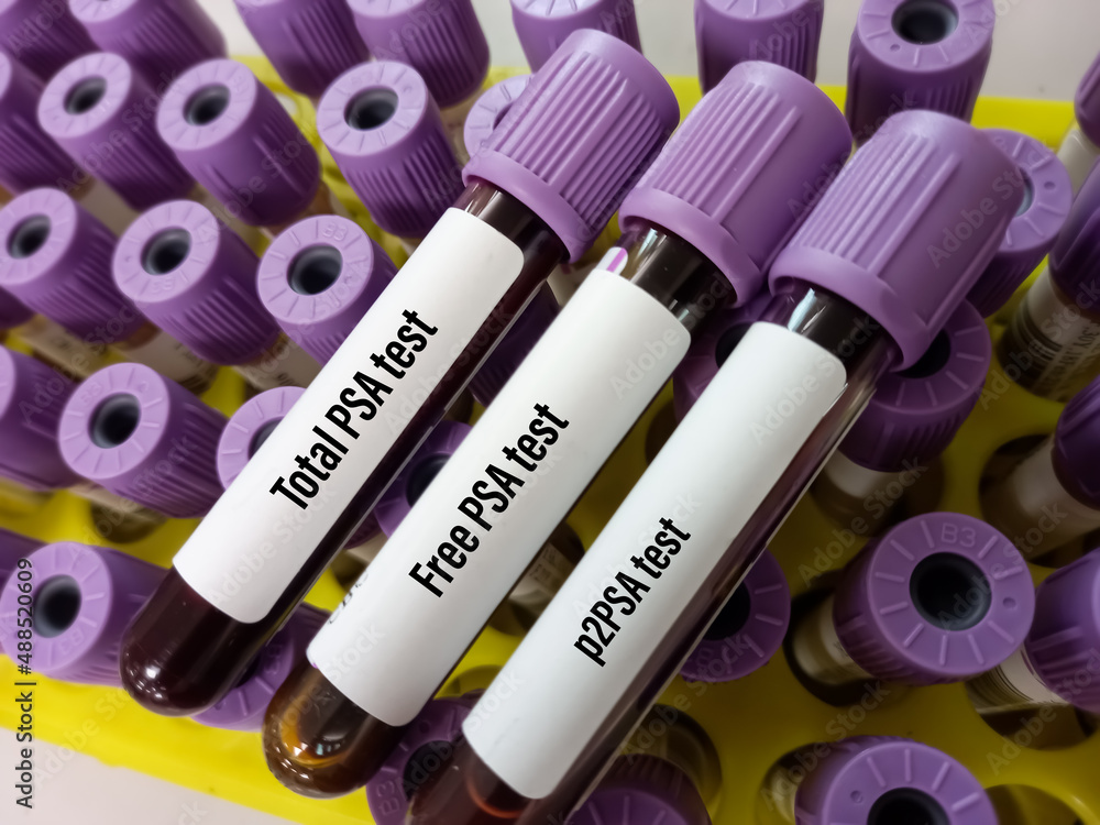 Blood sample tube with sample for PSA (Total, Free, p2) test. Prostate ...