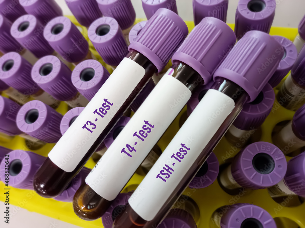 Blood sample for Thyroid panel hormone test for T3, T4, TSH with ...