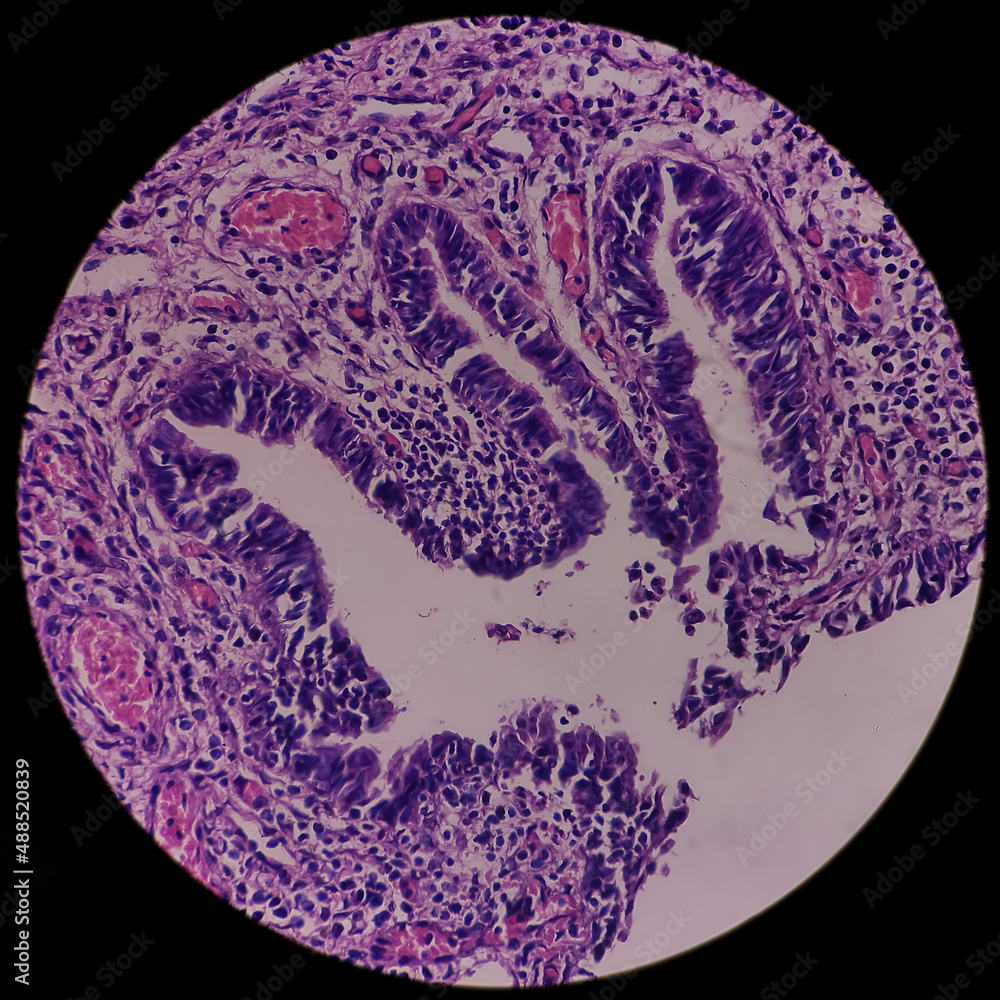 Urinary bladder(biopsy): Chronic cystitis, microscopic show bladder ...