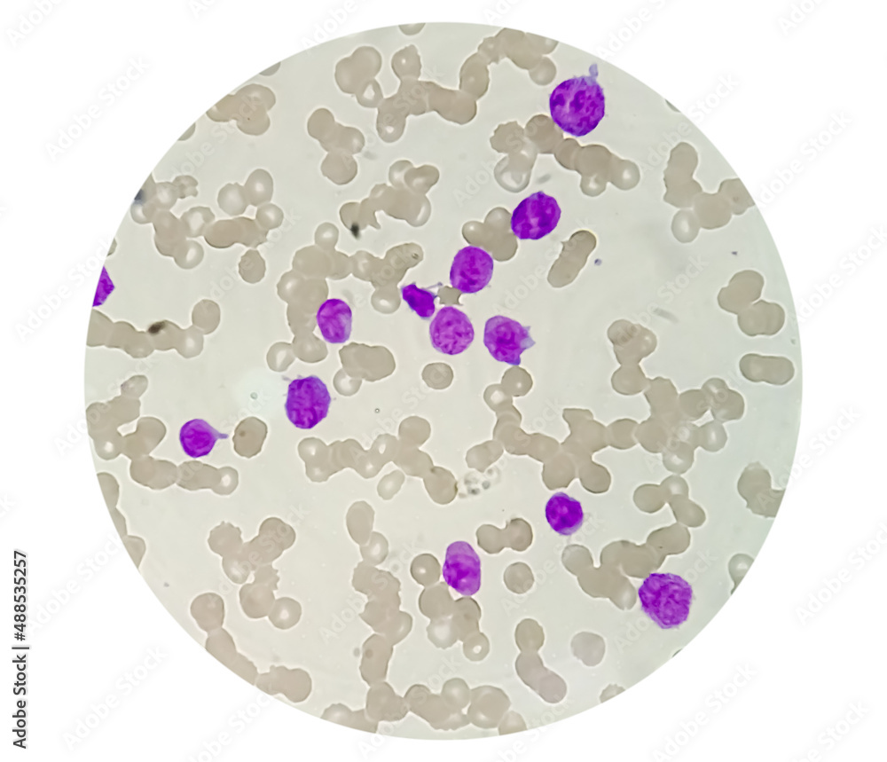 1000x, abnormal, acute, all, aml, analyzing, apl, blast, blood, bone ...