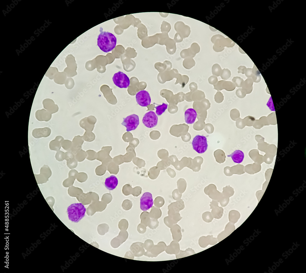 1000x, abnormal, acute, all, aml, analyzing, apl, blast, blood, bone ...