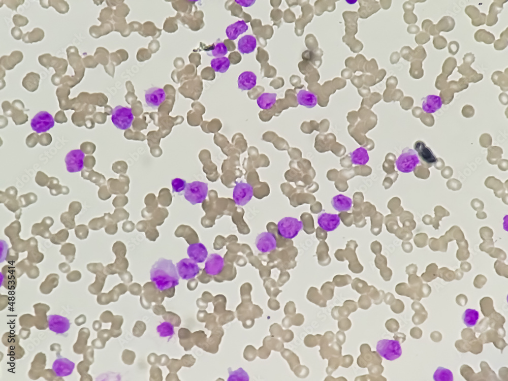 1000x, abnormal, acute, all, aml, analyzing, apl, blast, blood, bone ...