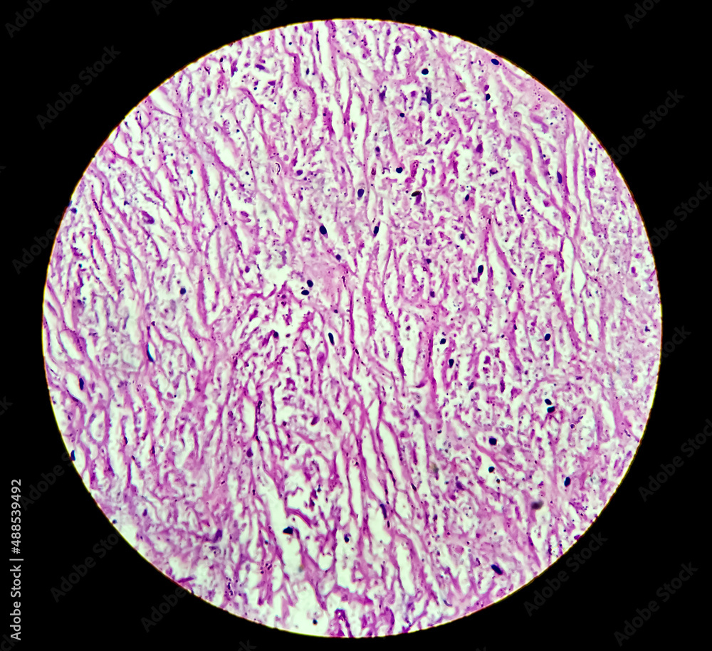 Tissue form Gallbladder (Laparoscopic cholecysectomy) hematoxylin and ...