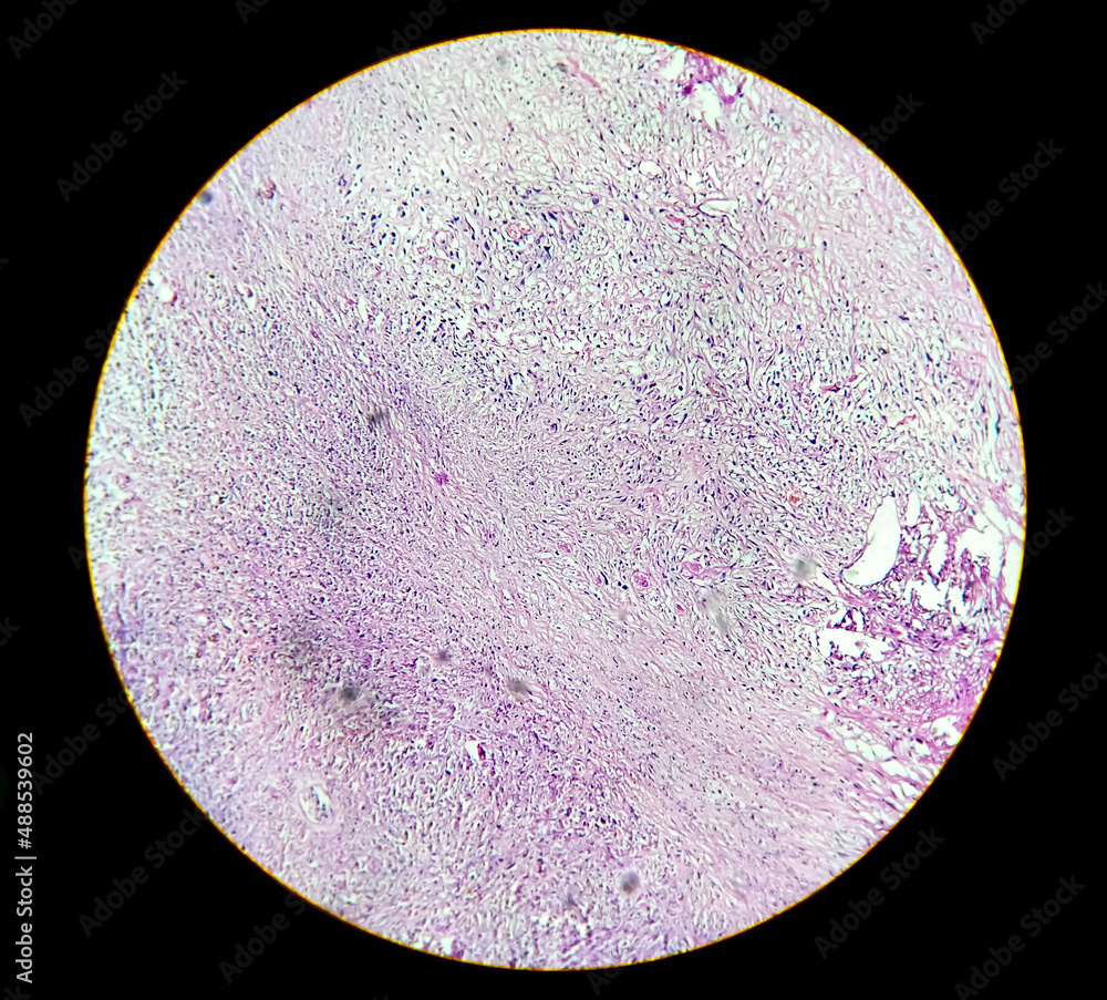 Carcinosarcoma of gallbladder. Histology analyzed by microscope ...