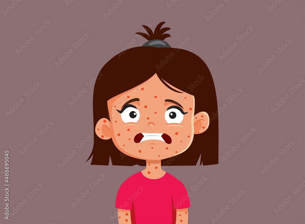 Little Girl Suffering from Measles Vector Cartoon Illustration Stock ...