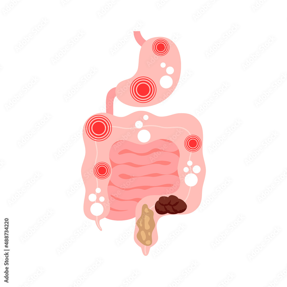 Irritable bowel syndrome, IBS. Symptoms in intestine and stomach pain ...