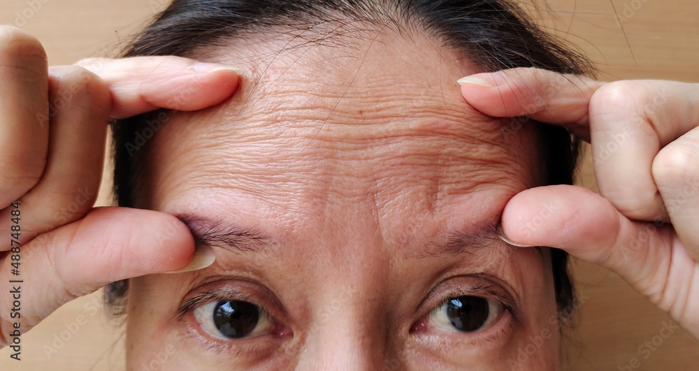 Portrait showing the fingers squeezing forehead, problem flabbiness and ...
