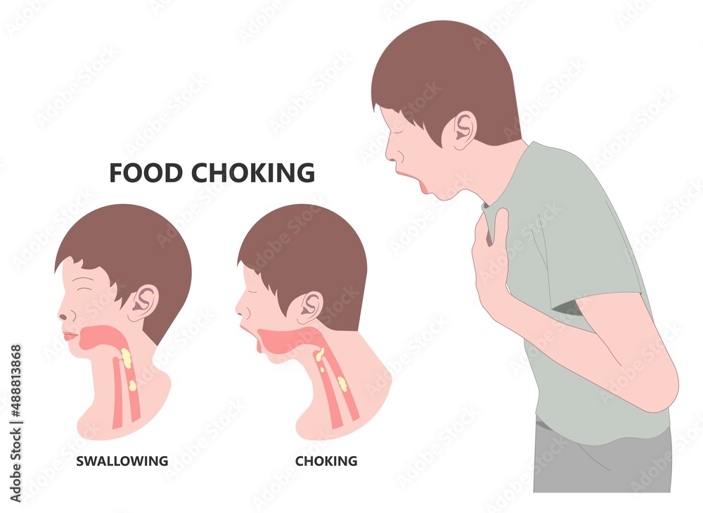 Choking first aid baby food CPR child step lodges blocking victim adult help abdomen kids ...