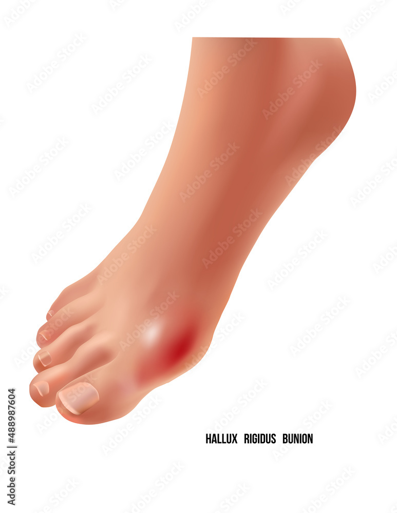 Arthritic hallux rigidus bunion rheumatoid sore joints, top view. Stock ...