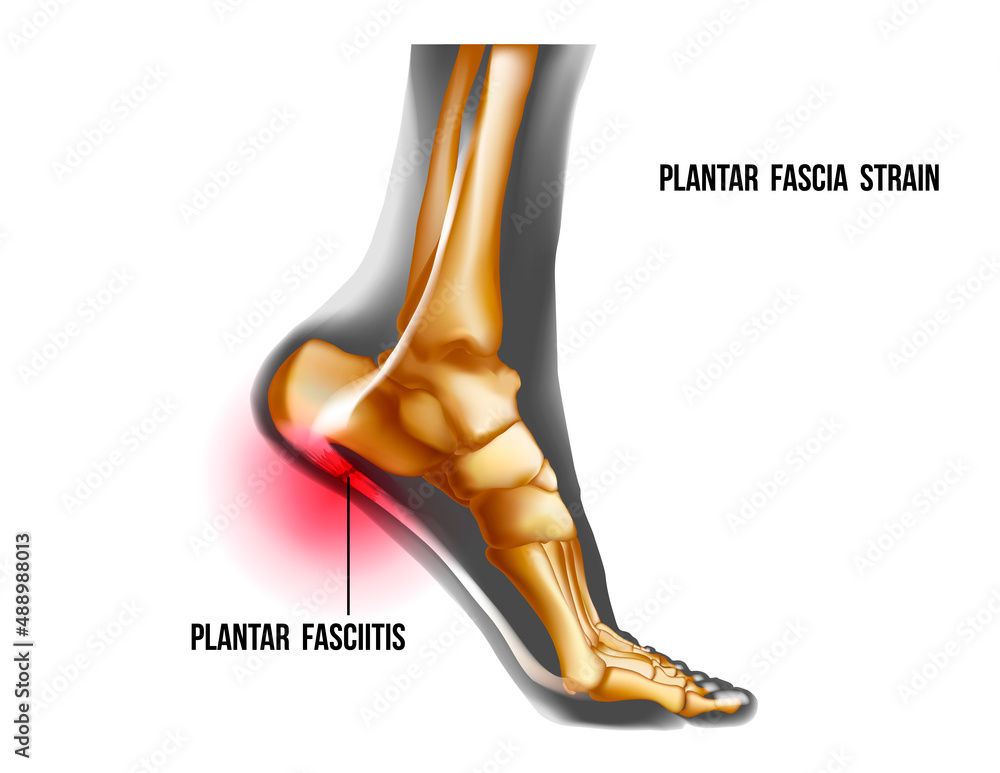 Plantar fasciitis inflammation and ruptures strain. Foot pain ...