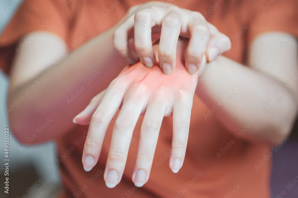 The woman's hand had a red rash and itching, so she scratched due to an ...