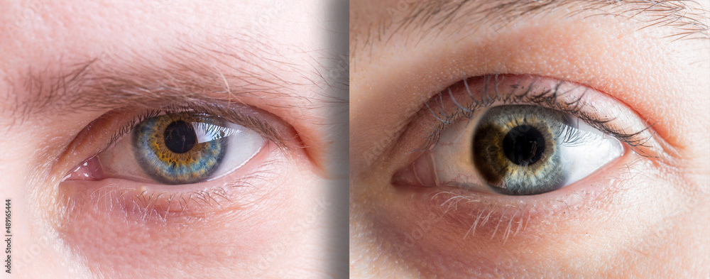 Person blue and brown colors eye iris close up, heterochromia ...
