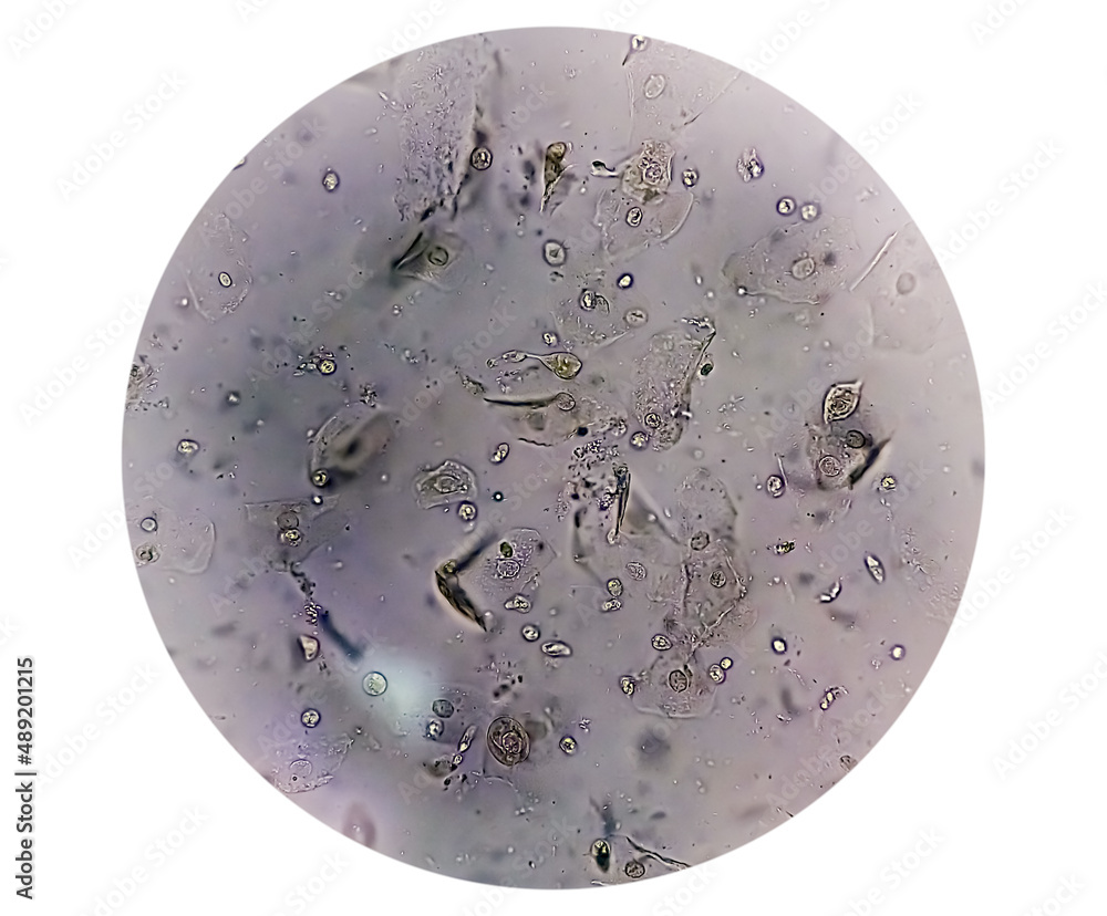 Microscopic image show Pus cells and Epithelial cells . Urinary tract ...