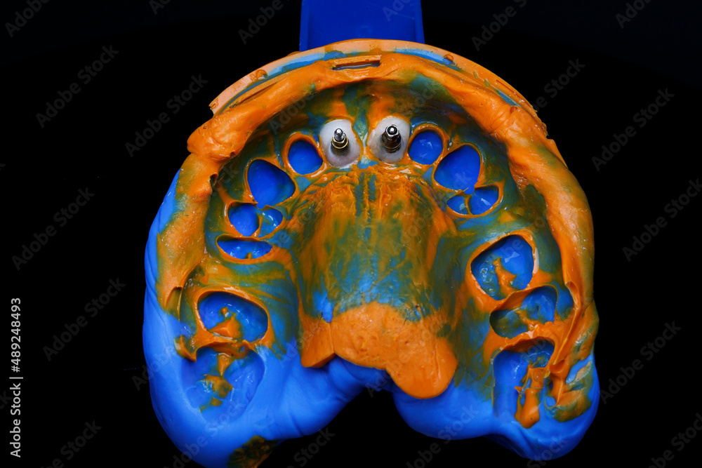 dental impression from special silicone with two crowns of central ...