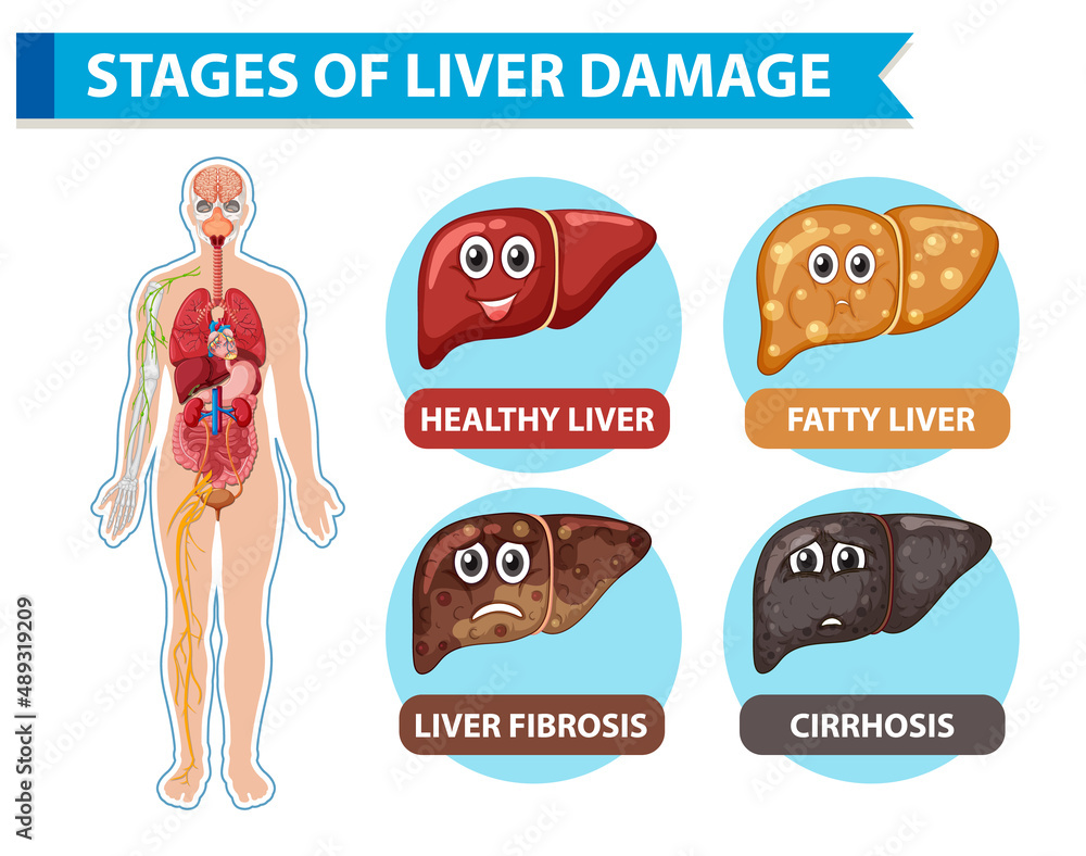 Diagram showing stages of liver damage Stock Vector | Adobe Stock