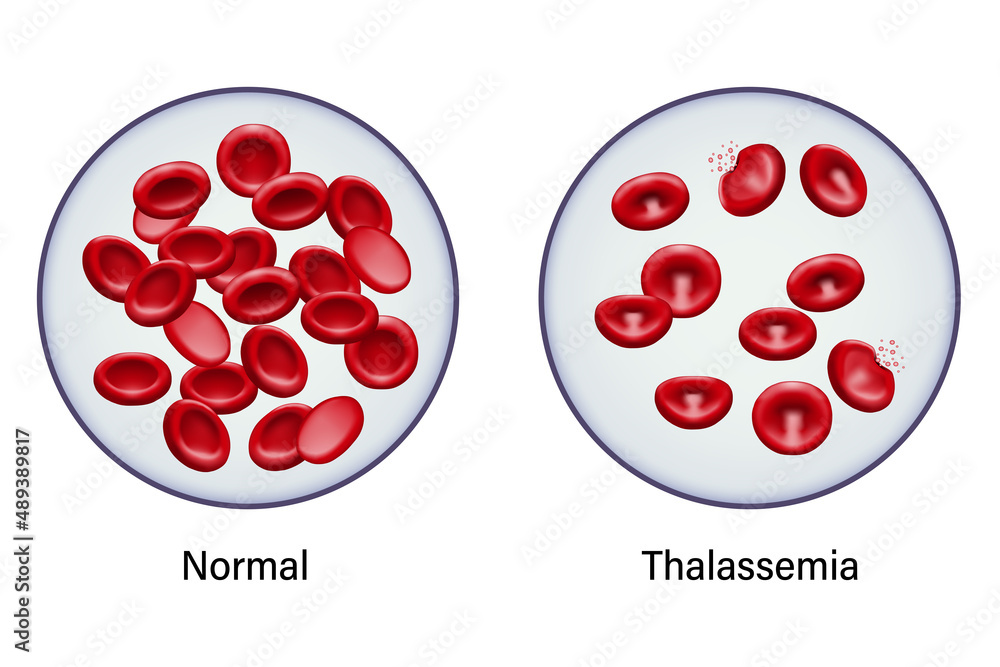 Normal Red Blood Cells