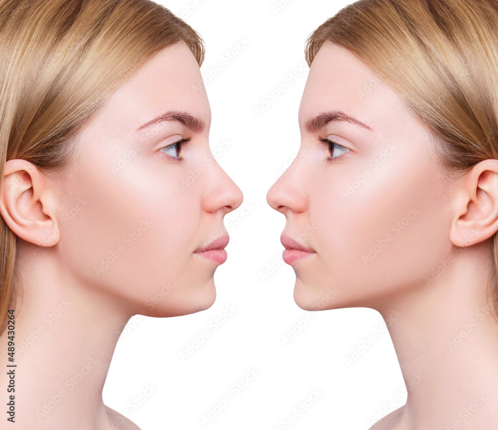 Young woman before and after chin correction. Over white background ...
