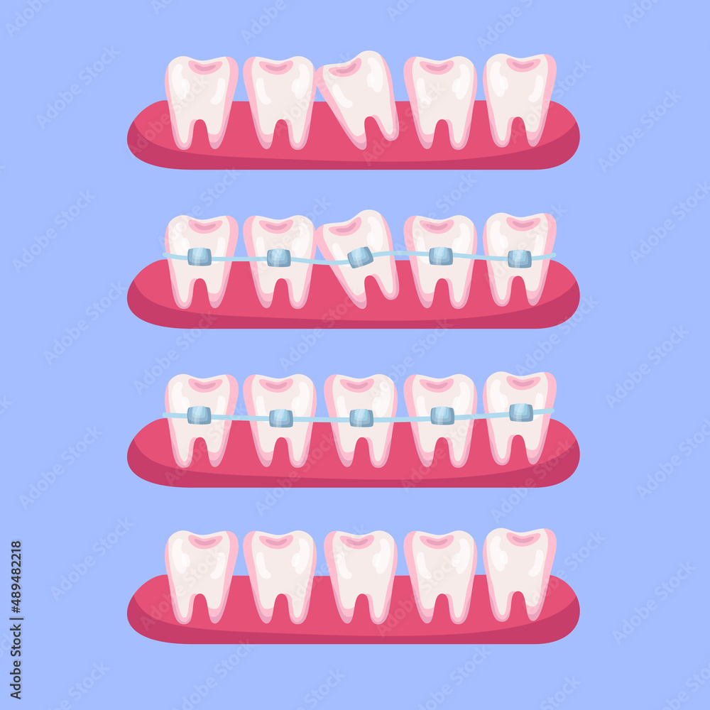 Teeth before and after braces cartoon illustration set. Stages of ...