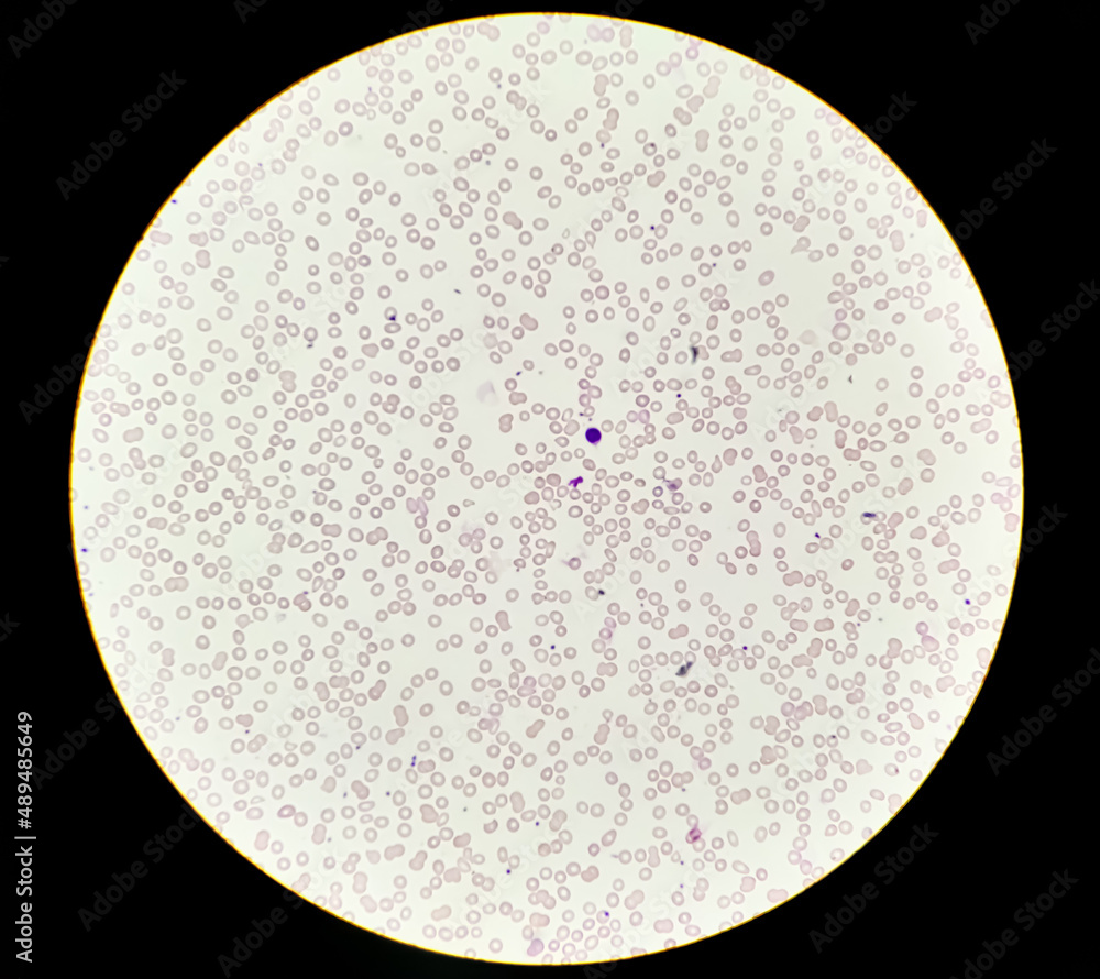 Hereditary hemolytic anemia. Hemoglobin E (HbE) disease, hypochromia ...