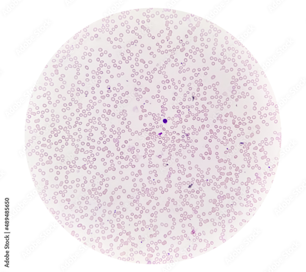 Hereditary hemolytic anemia. Hemoglobin E (HbE) disease, hypochromia ...
