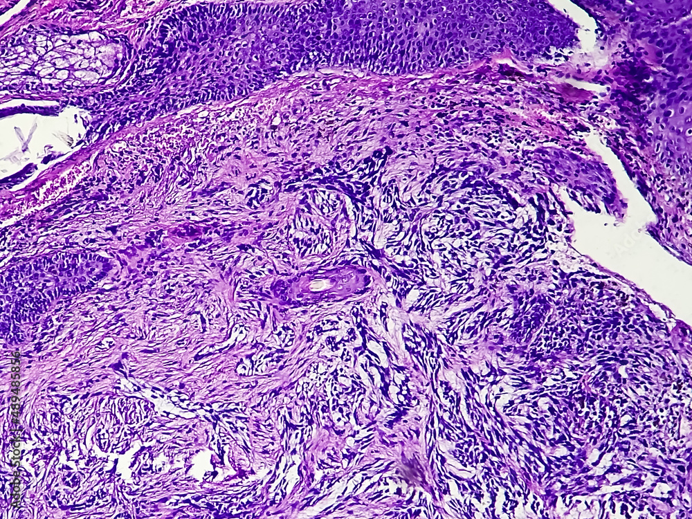 Skin biopsy pathology of basal cell carcinoma. The most common type of ...