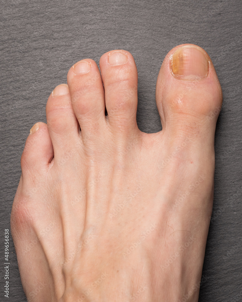 Toenails with fungus problems,Onychomycosis, also known as tinea ...