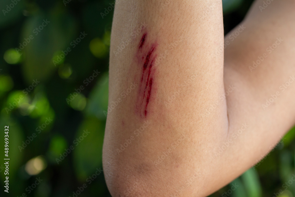 Wounds on the arm of a men due to an accident from fall. Stock Photo ...
