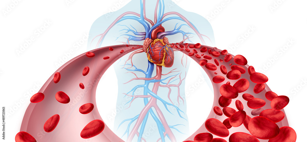 Anemia Anaemia Disease medical diagram concept as abnormal and normal ...