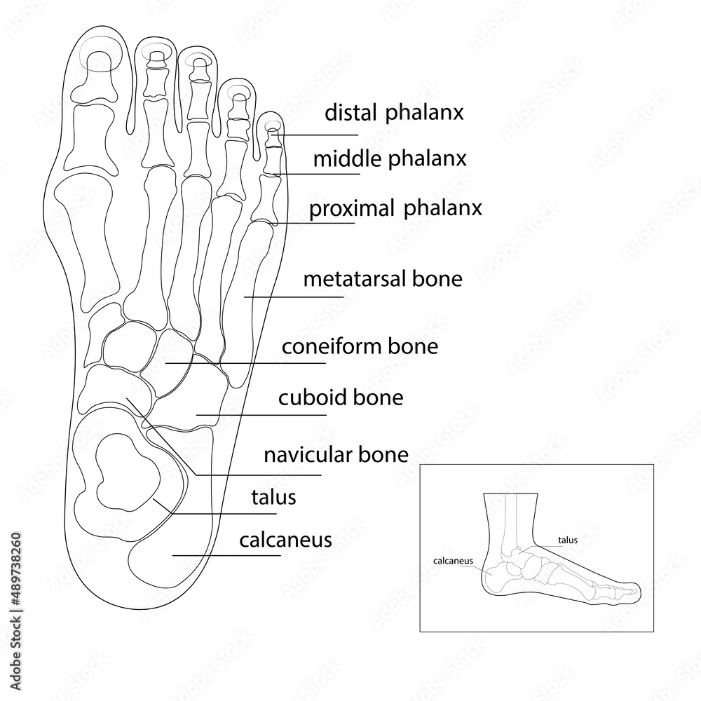 Bursitis on the sides of the foot. The bone and skin on the sides of ...