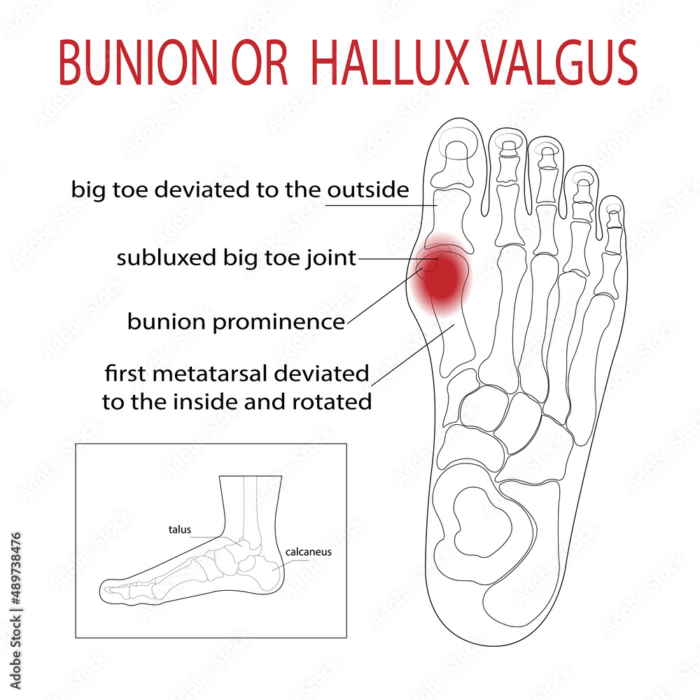 Bursitis on the sides of the foot. The bone and skin on the sides of ...
