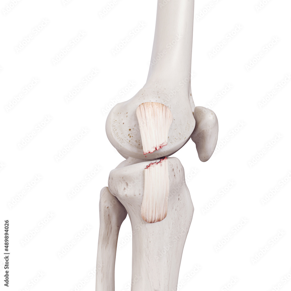 3d rendered medically accurate illustration of a torn tibial collateral ...