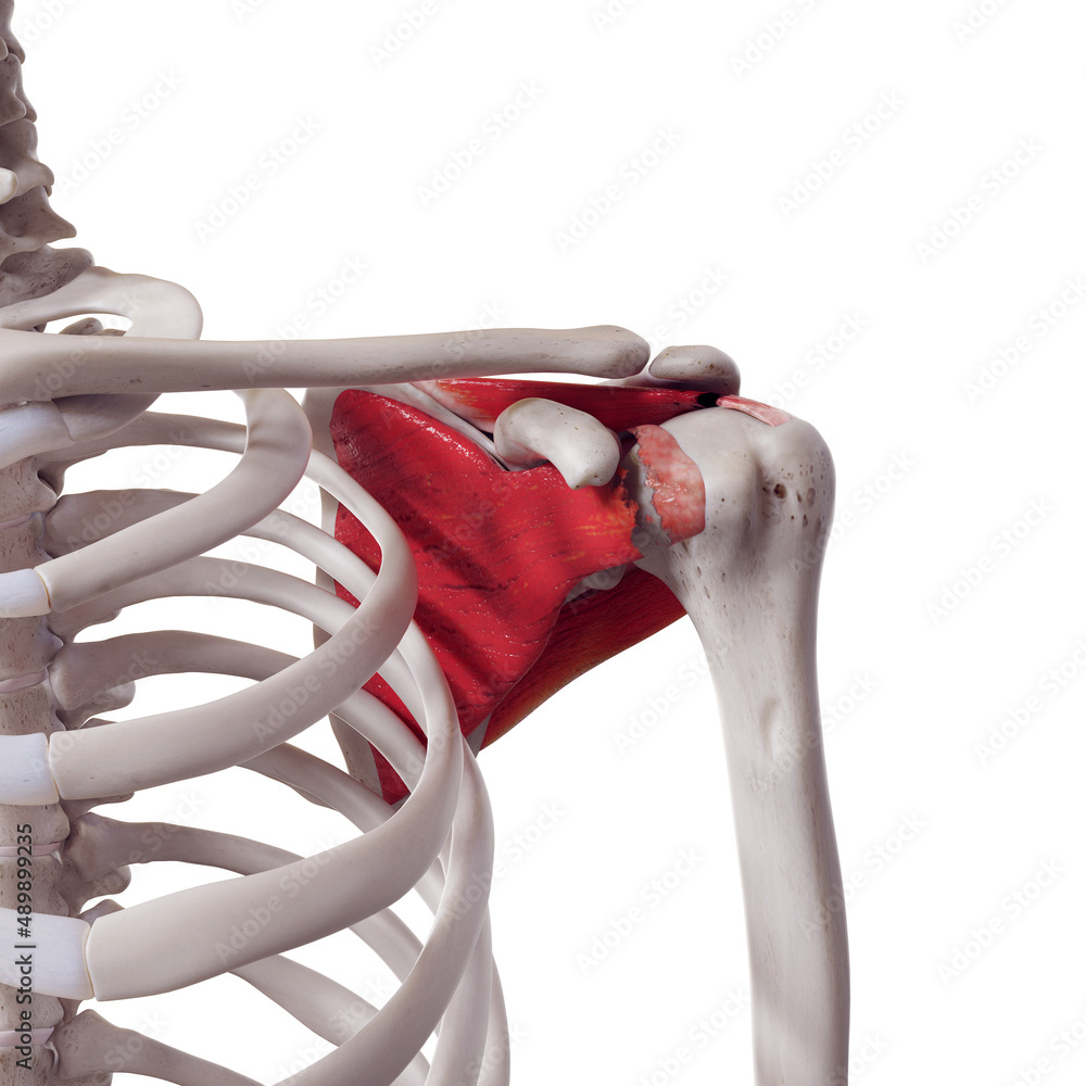 3d rendered medically accurate illustration of a torn rotator cuff ...