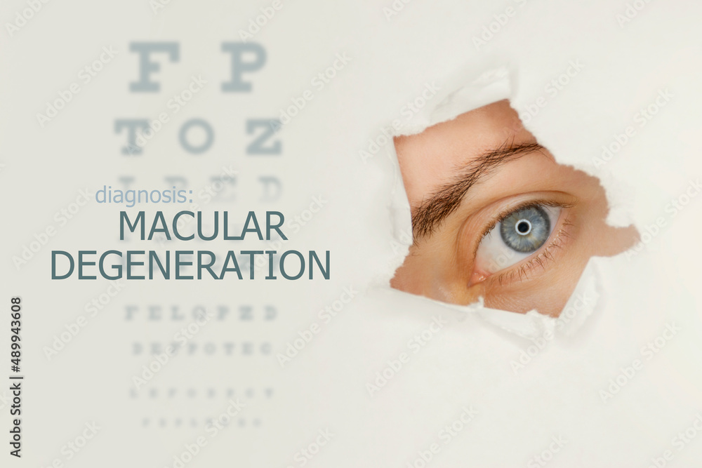 Macular degeneration disease poster with eye test chart and blue eye ...