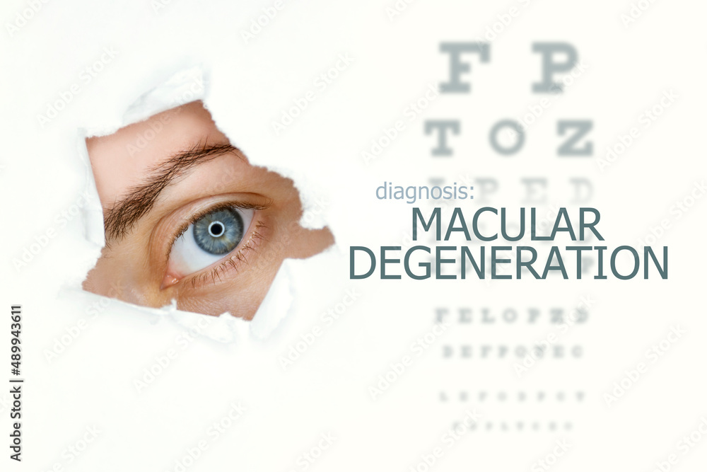 Macular degeneration disease poster with eye test chart and blue eye ...