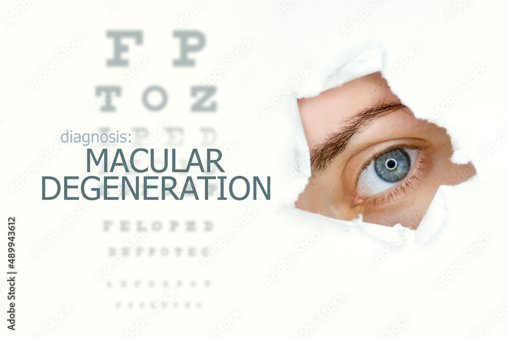 Macular degeneration disease poster with eye test chart and blue eye ...