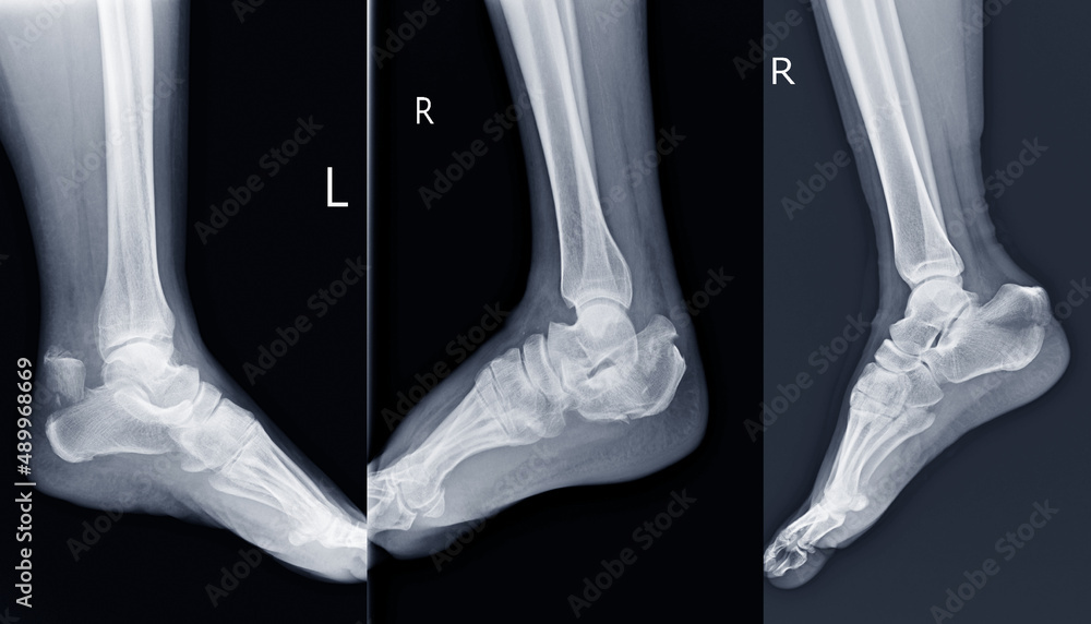 Film ankle X-ray radiograph showing heel bone broken 3 views (close ...