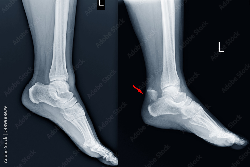 Film ankle X-ray radiograph showing heel bone narmal and broken on red ...