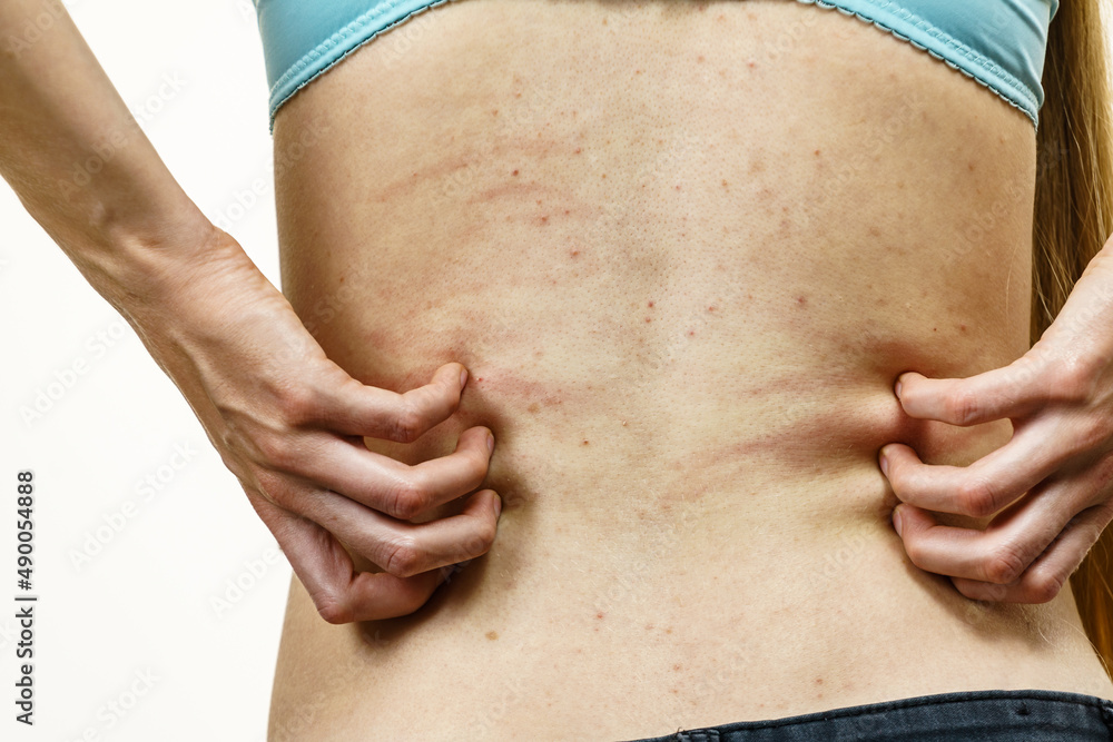 Poster Woman scratching her itchy back with allergy rash – Wall Art ...