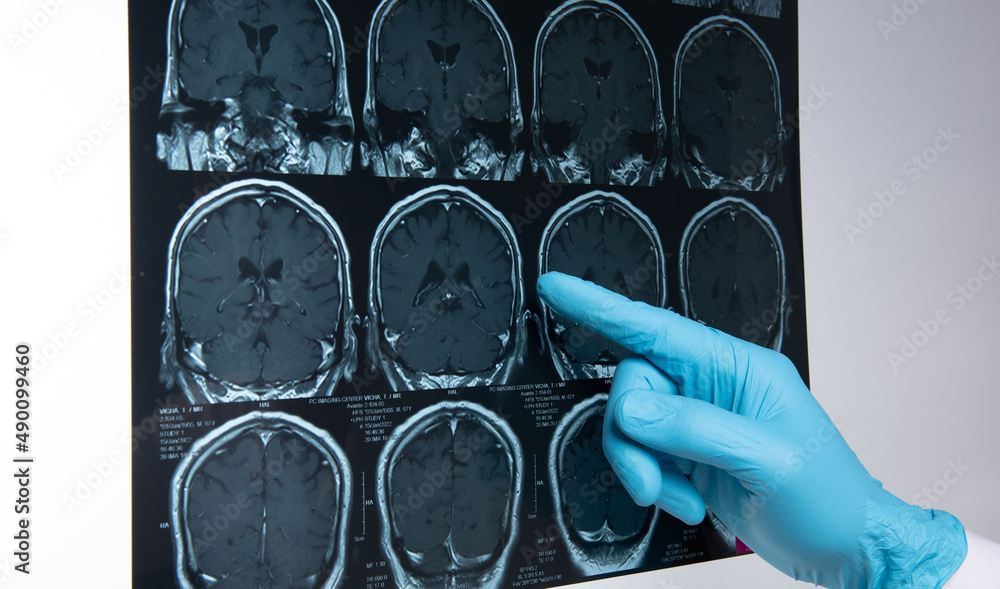 Doctors reviewing brain x-rays;MRI of the blood vessels in the brain ...