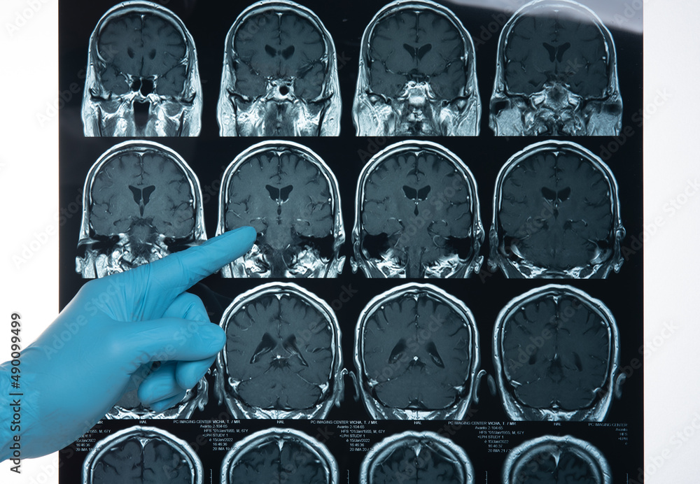 Doctors reviewing brain x-rays;MRI of the blood vessels in the brain ...