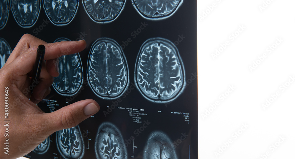 Doctors reviewing brain x-rays;MRI of the blood vessels in the brain ...