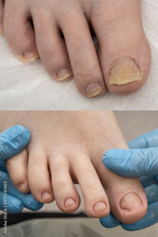 collage before and after medical pedicure.treatment of onychomycosis ...