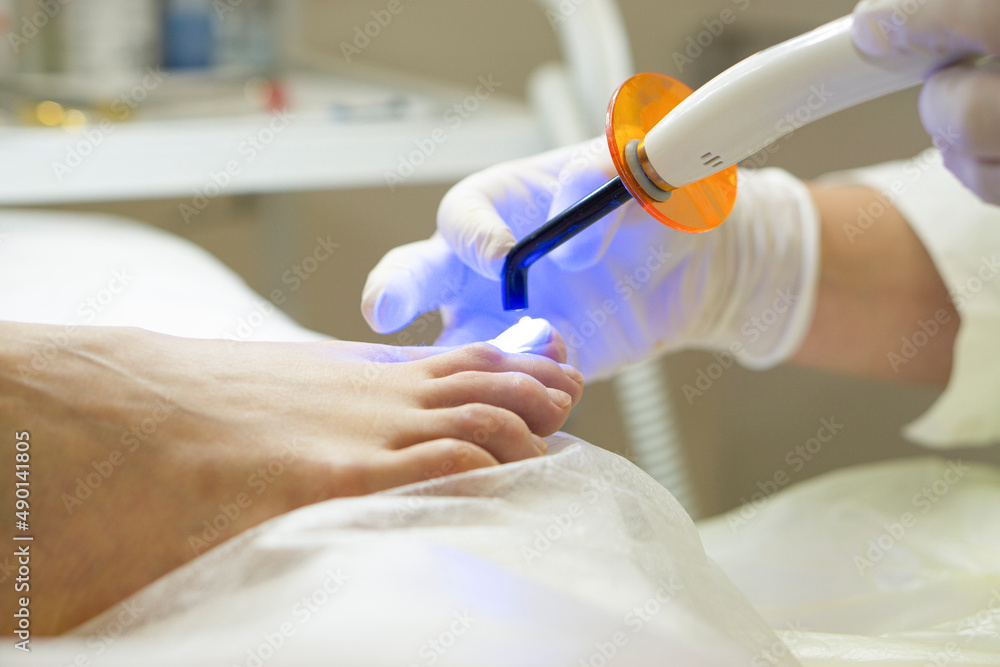 An orthopedist puts a metal nail clamp on an ingrown toenail. It shines ...