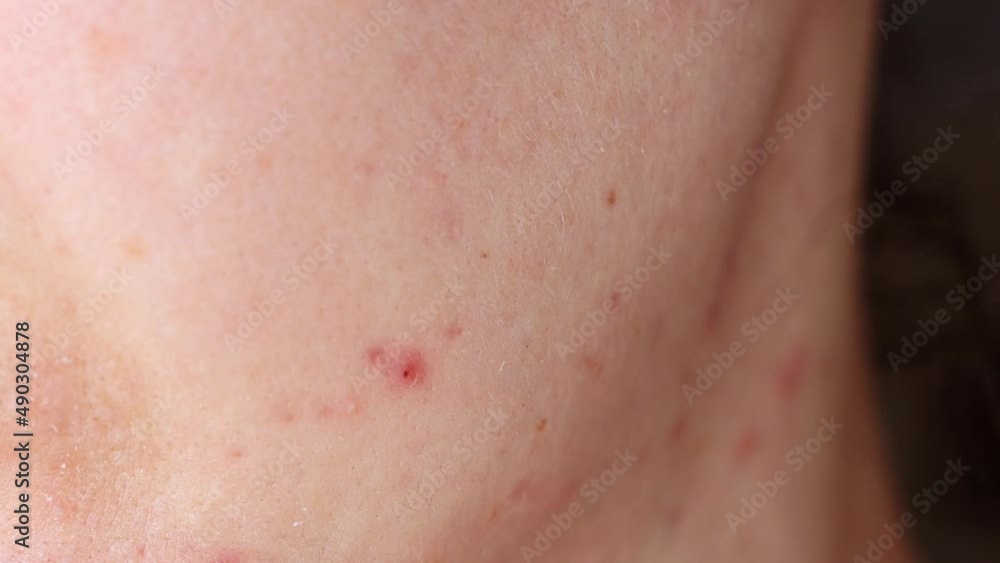 Sick skin of the face of a young girl close-up. Allergic reaction ...