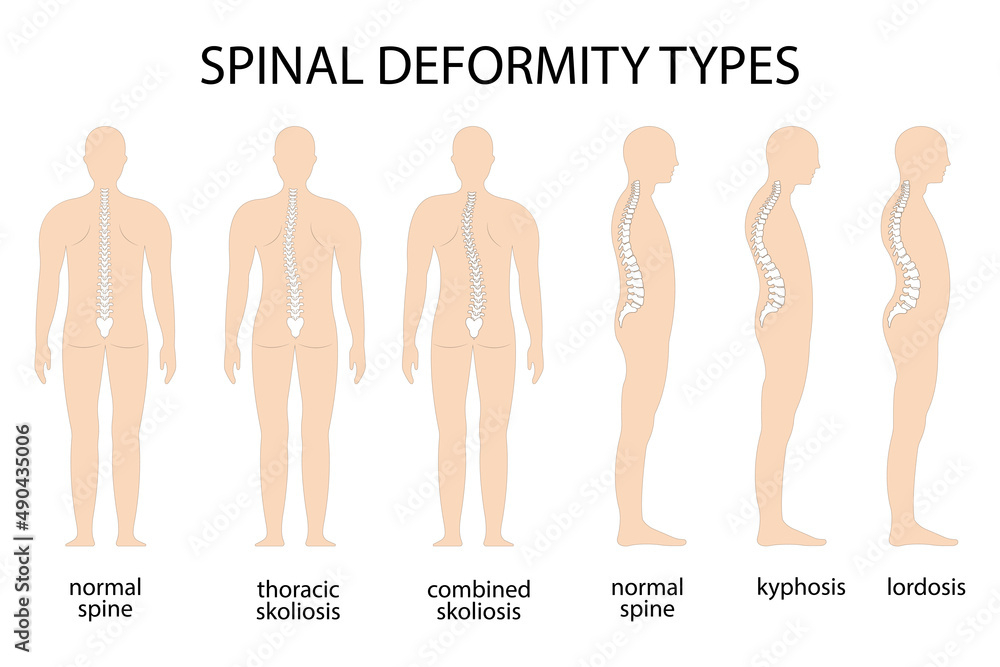 Spine deformity vector illustration. Kyphosis, lordosis spine ...