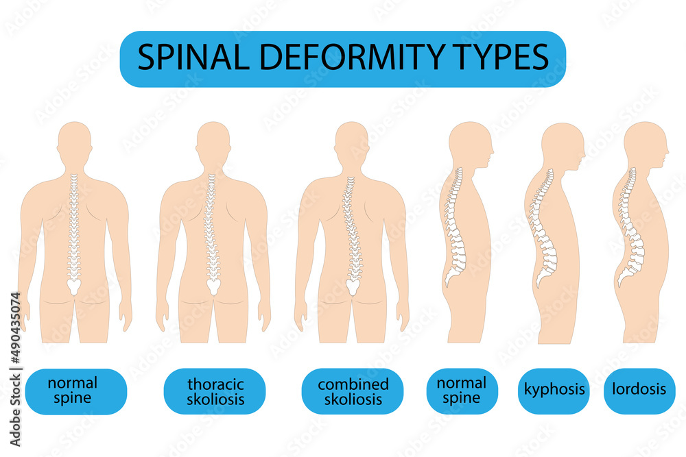 Spine deformity vector illustration. Kyphosis, lordosis spine ...